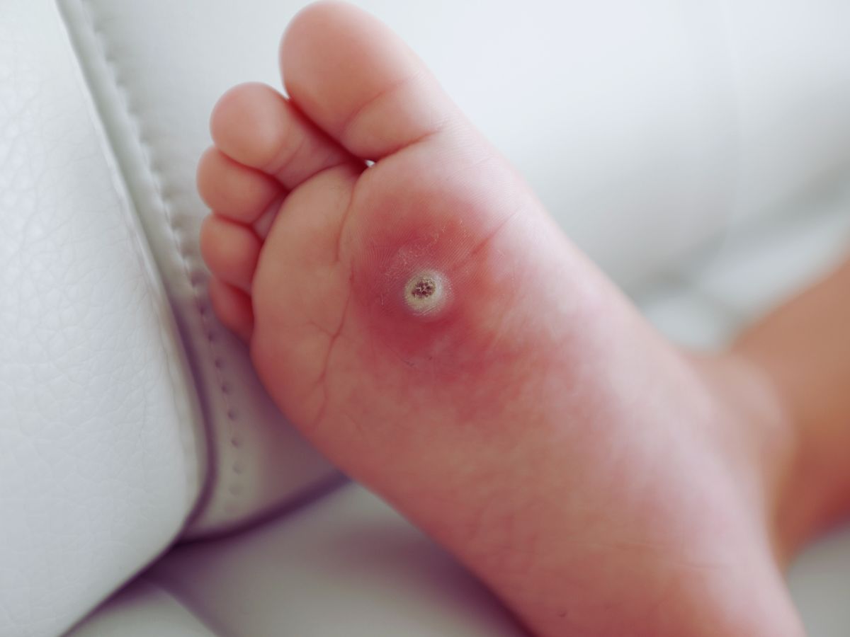 Cómo quitar una verruga plantar de forma efectiva y segura